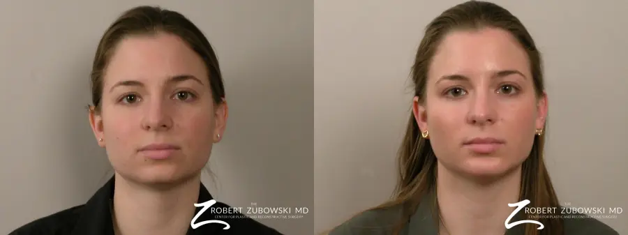 Cleft Chin Removal Before And After