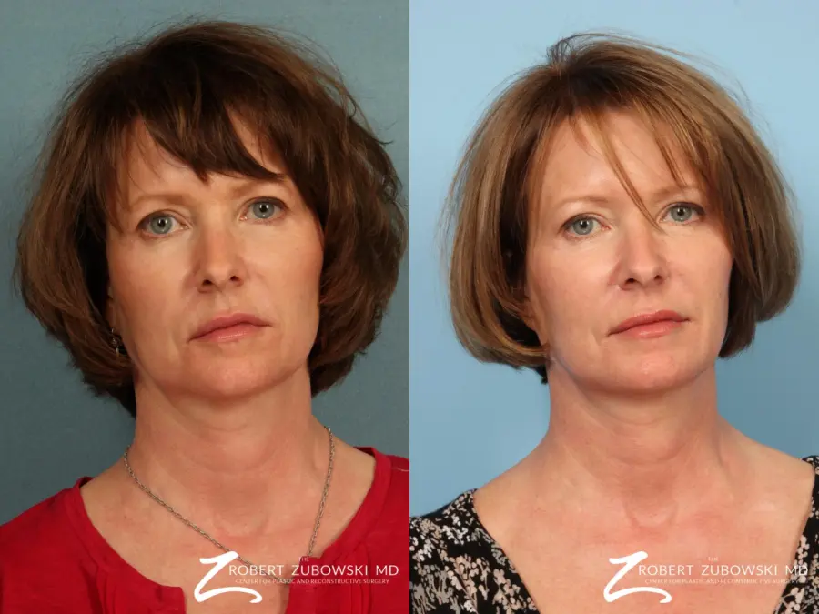 Ultherapy® Before & After Gallery