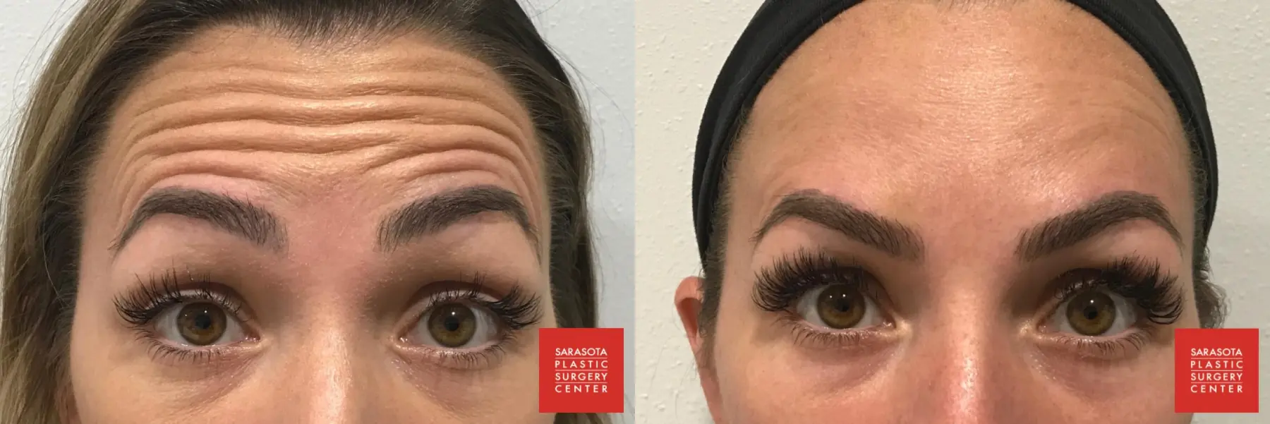 BOTOX® Cosmetic Before & After Gallery: Patient 3