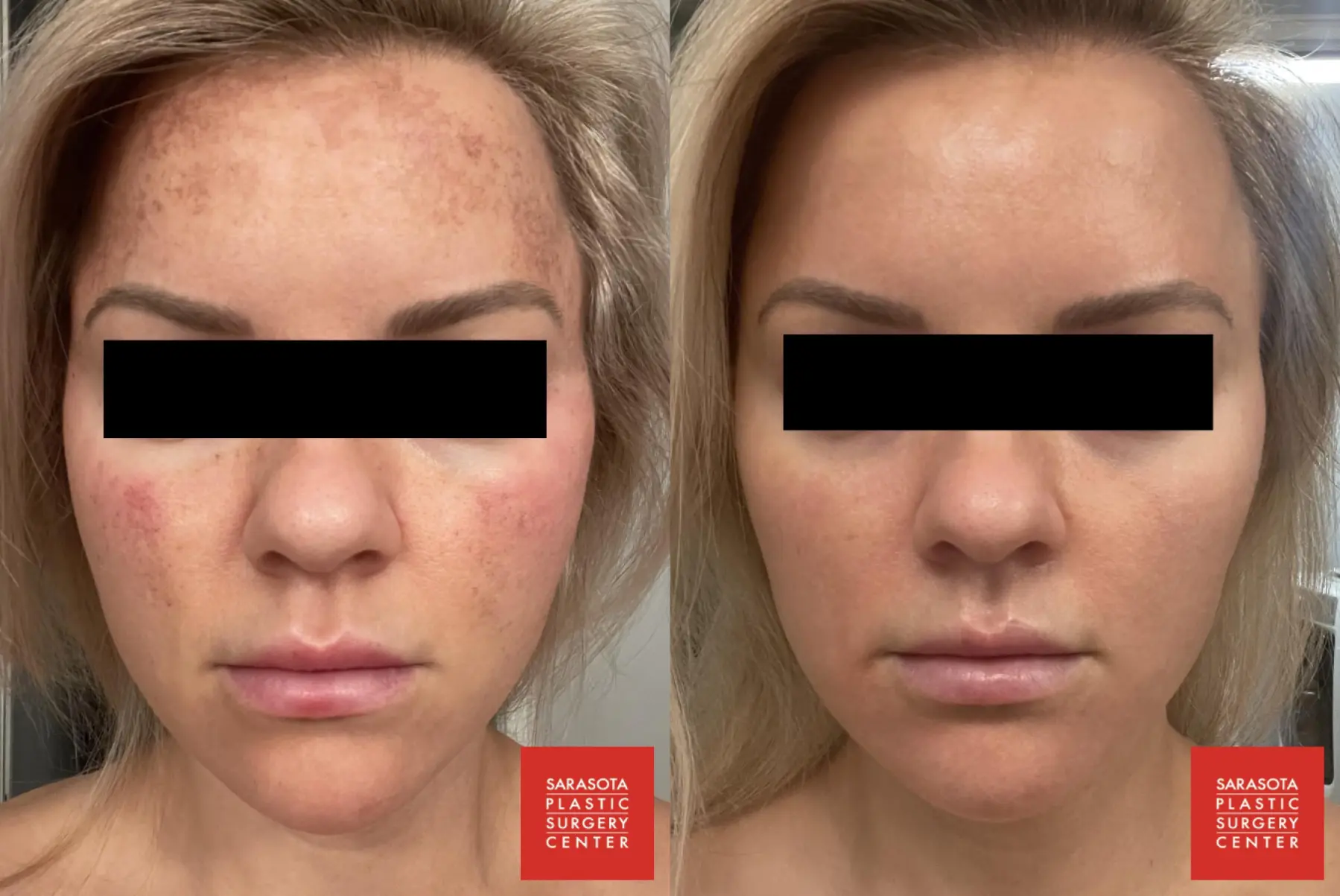 Intense Pulsed Light (IPL) Before & After Gallery