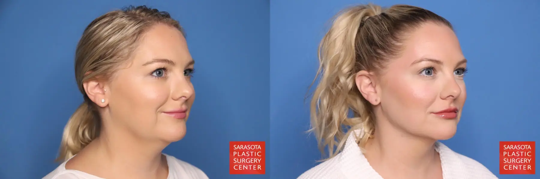 Buccal Fat Pad Removal Before & After Gallery: Patient 1