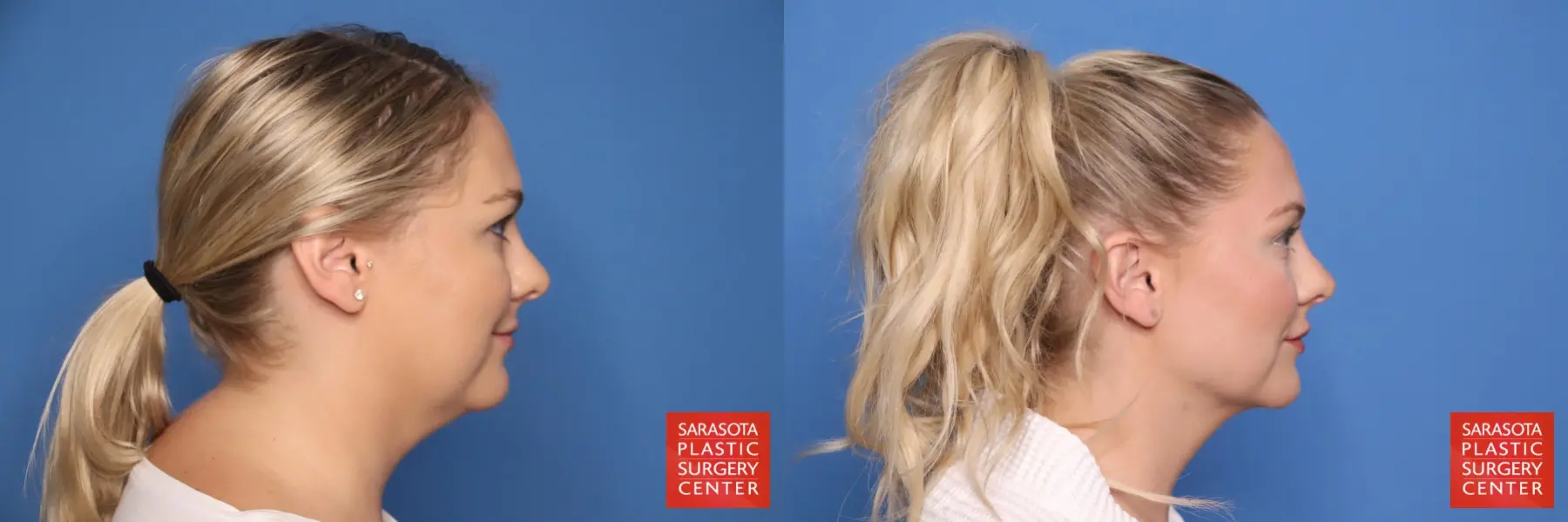 Buccal Fat Pad Removal Before & After Gallery: Patient 1