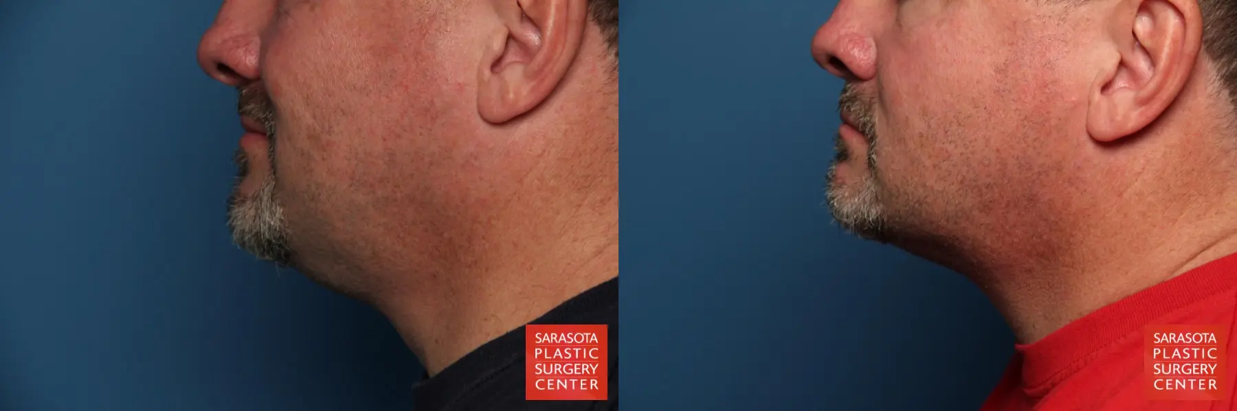 Facial Liposuction Before & After Gallery: Patient 2