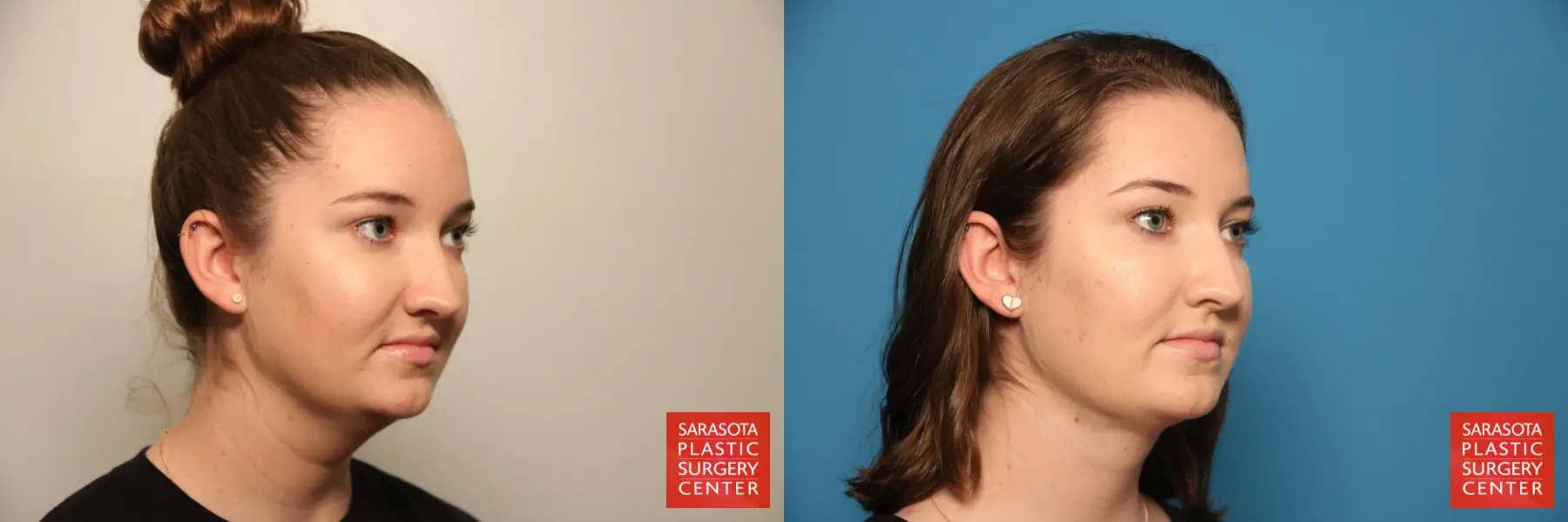 Facial Liposuction Before & After Gallery: Patient 4