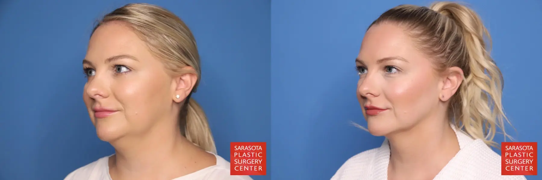 Facial Liposuction Before & After Gallery: Patient 8