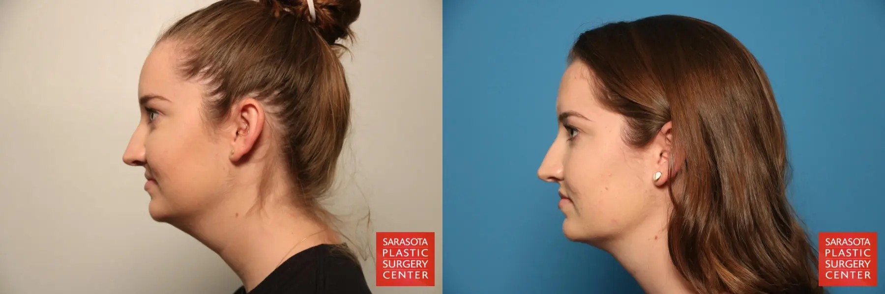 Facial Liposuction Before & After Gallery: Patient 4