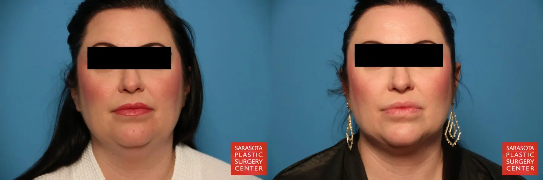 Facial Liposuction Before & After Gallery