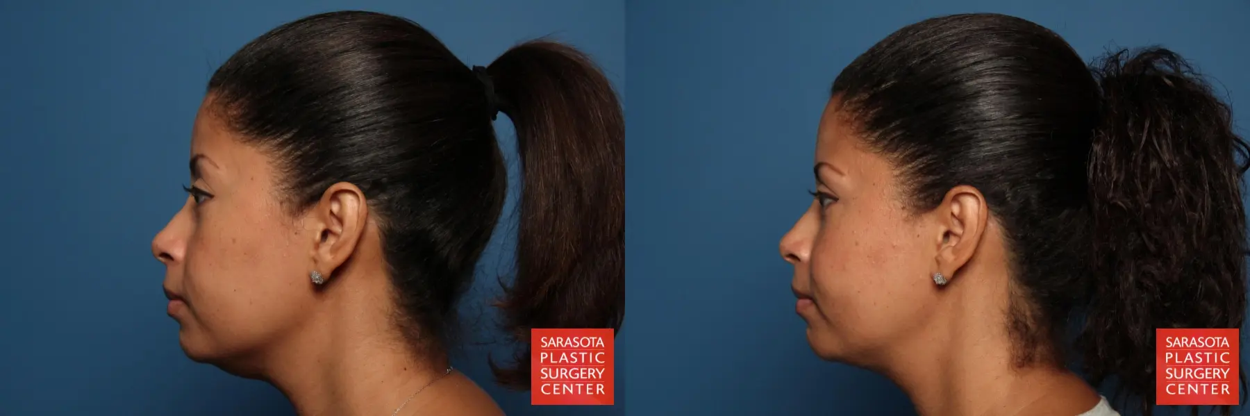 Facial Liposuction Before & After Gallery: Patient 3