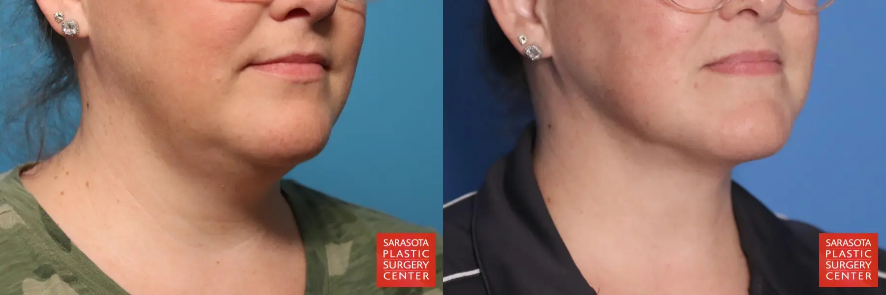 Facial Liposuction Before & After Gallery: Patient 7