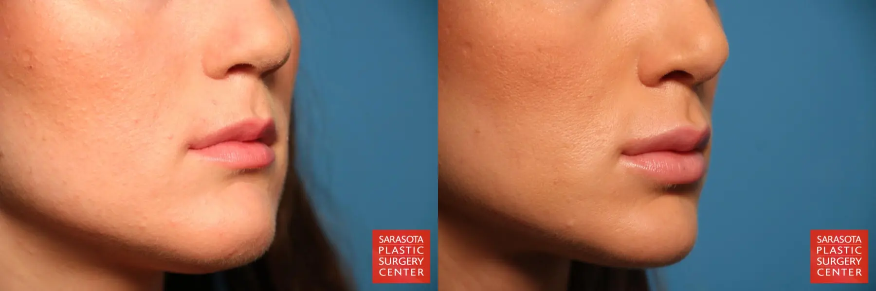 Fat Transfer Face Before & After Gallery: Patient 19