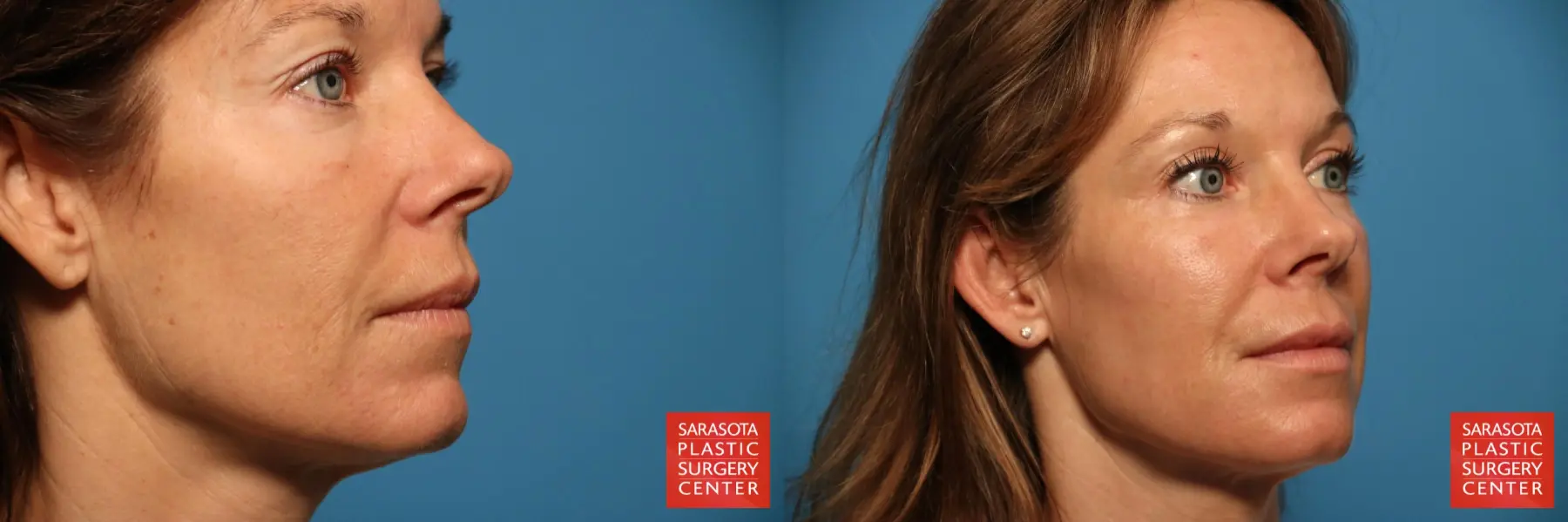 Fat Transfer Face Before & After Gallery: Patient 17