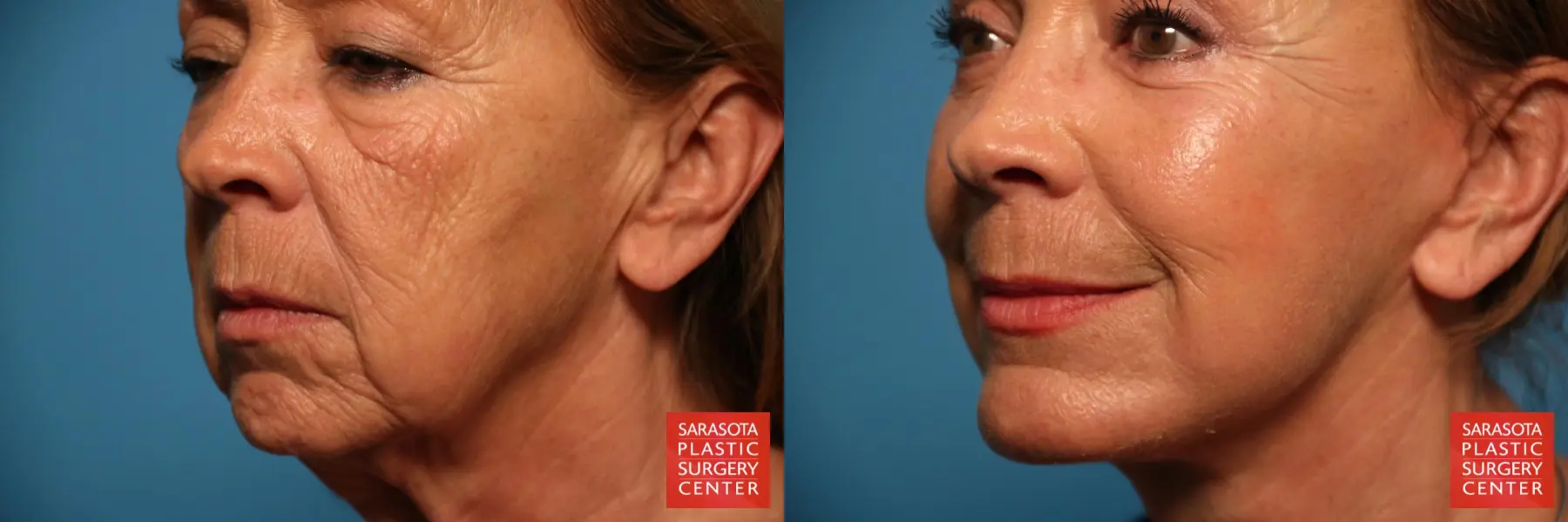 Laser Skin Resurfacing Face Before & After Gallery: Patient 28
