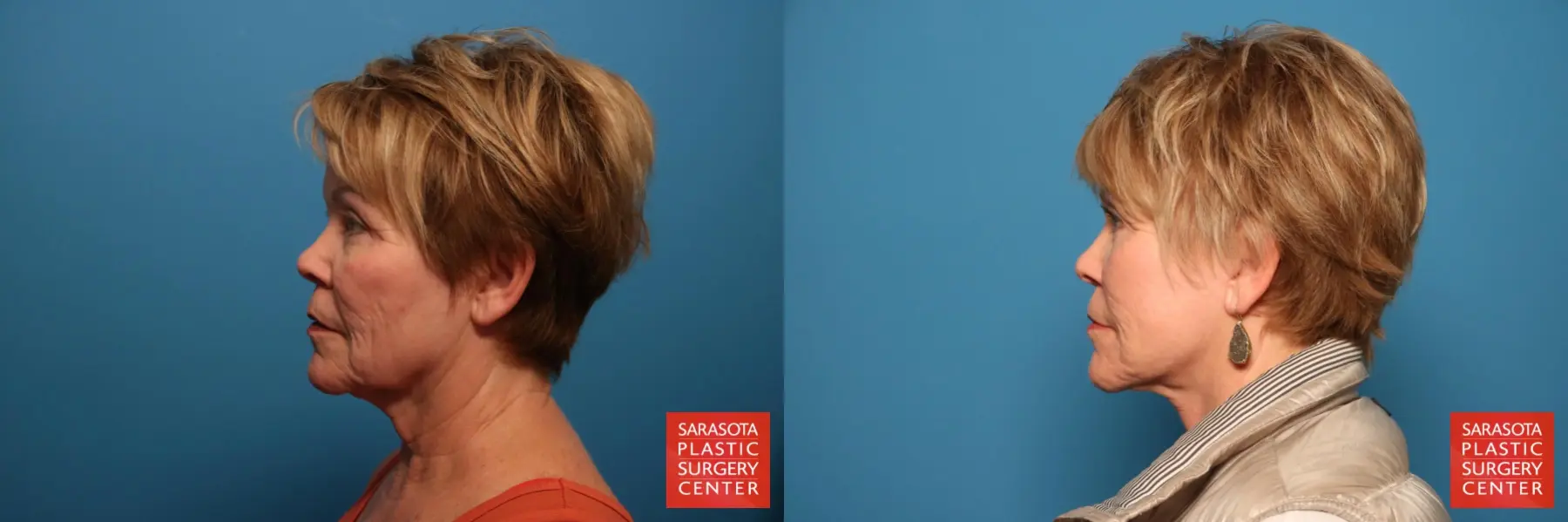 Laser Skin Resurfacing Face Before & After Gallery: Patient 29