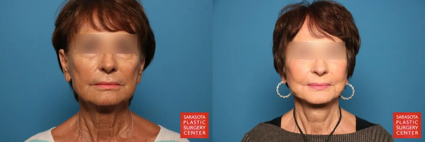 Laser Skin Resurfacing Face Before & After Gallery: Patient 10