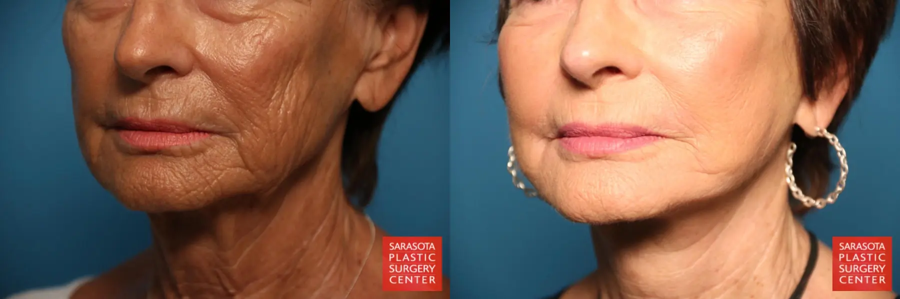 Laser Skin Resurfacing Face Before & After Gallery: Patient 10