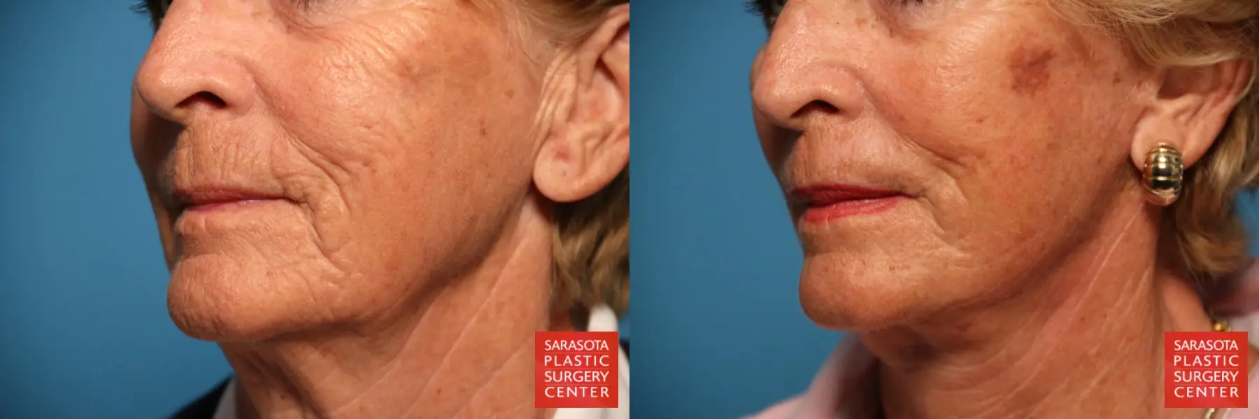 Laser Skin Resurfacing Face Before & After Gallery: Patient 14
