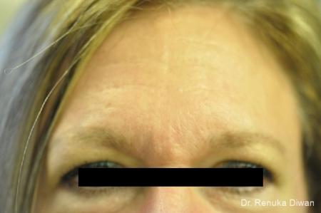 Frown lines Before & After Gallery