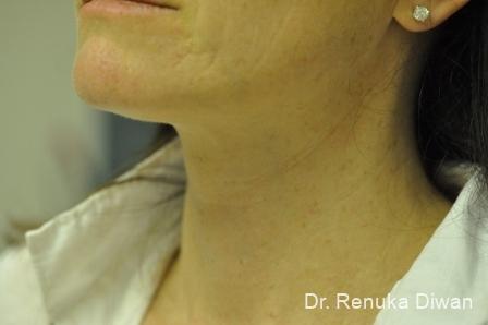 Neck Creases Before & After Gallery: Patient 3