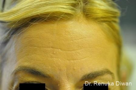 Forehead Creases Before & After Gallery