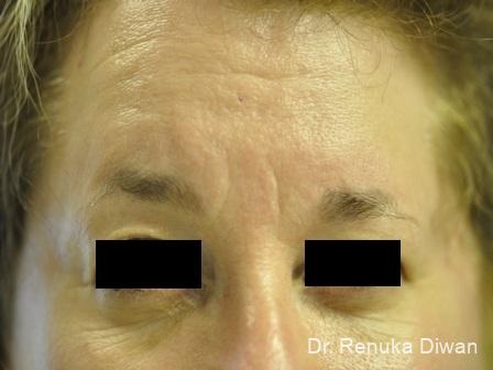 Forehead Creases Before & After Gallery