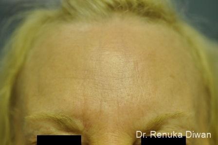 Forehead Creases Before & After Gallery