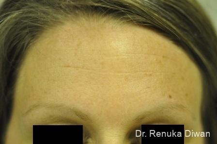 Frown lines Before & After Gallery