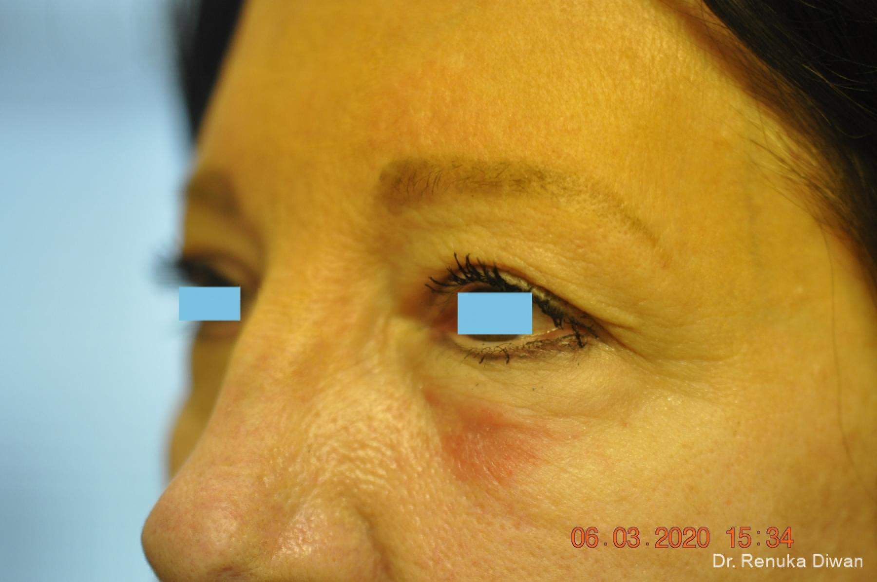 Blepharoplasty Before And After Gallery Patient 3