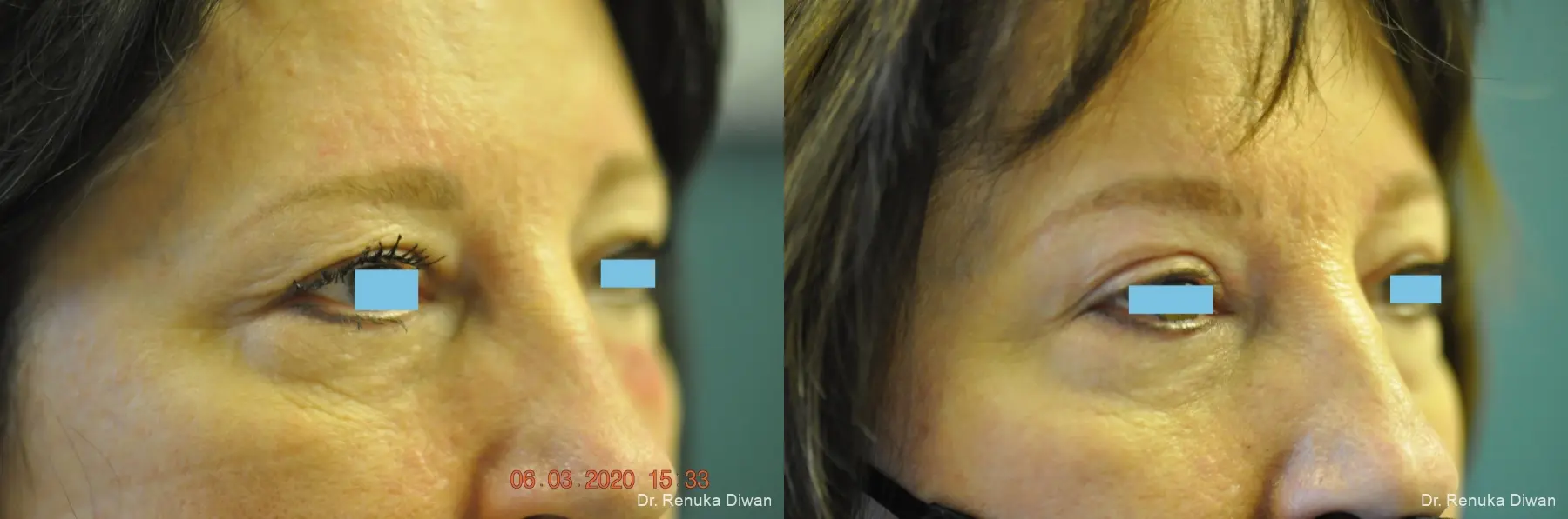 Blepharoplasty Before And After Gallery Patient 9