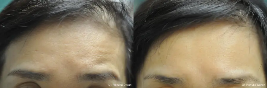 Forehead Creases Before & After Gallery: Patient 10