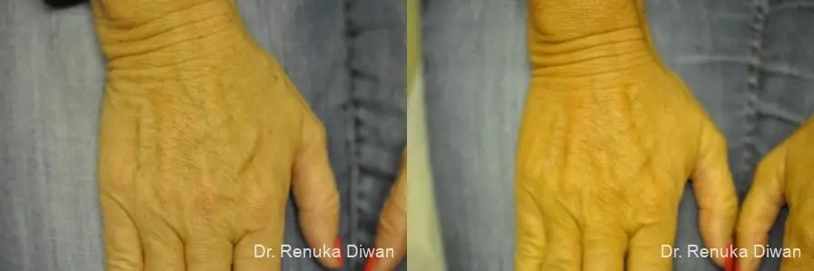 IPL Before & After Gallery