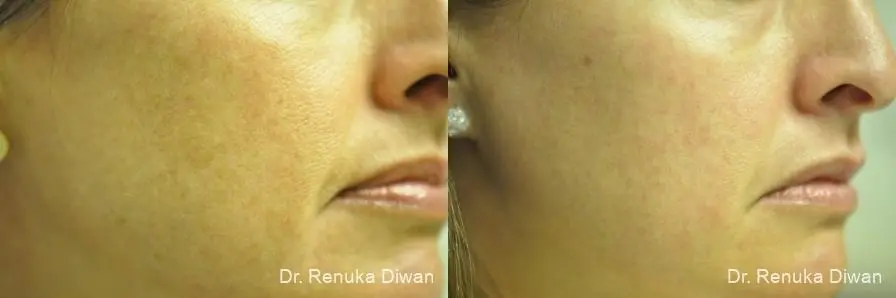 IPL Before & After Gallery