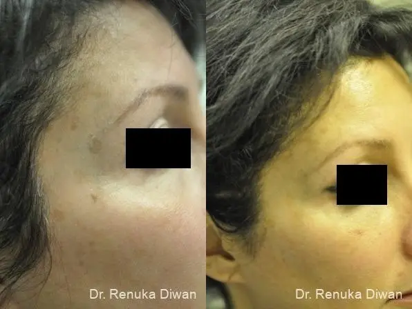 IPL Before & After Gallery