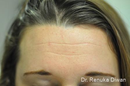 Forehead Creases Before & After Gallery: Patient 7