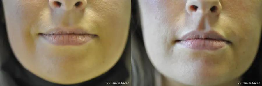 Lip Augmentation Before & After Gallery: Patient 17