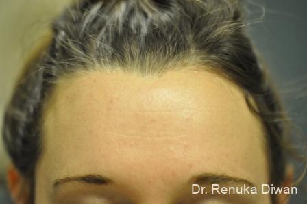 Forehead Creases Before & After Gallery: Patient 7