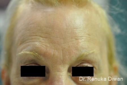 Forehead Creases Before & After Gallery