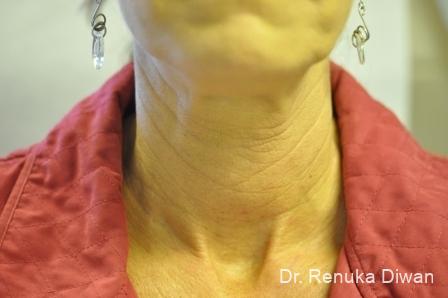 Neck Creases Before & After Gallery: Patient 2