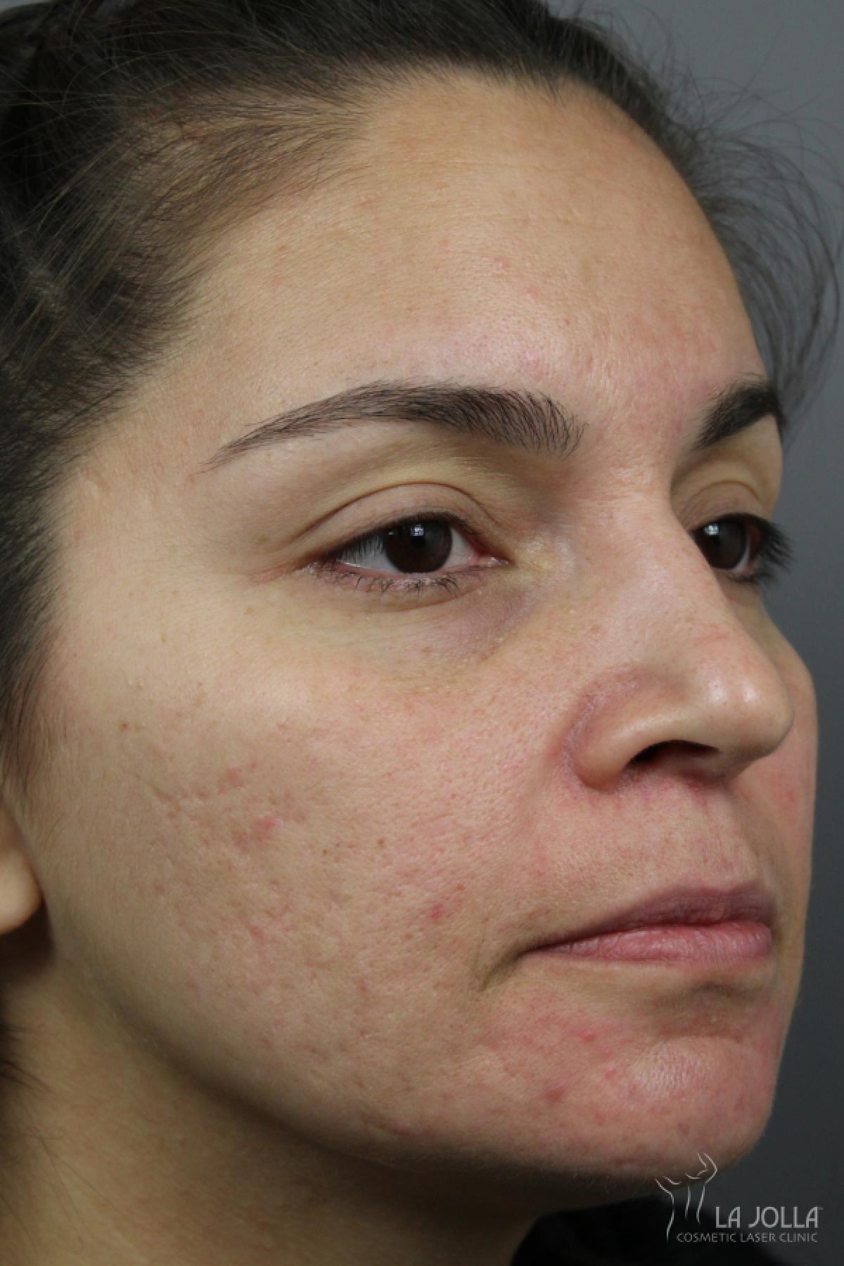 Acne Scars Before & After Gallery: Patient 3