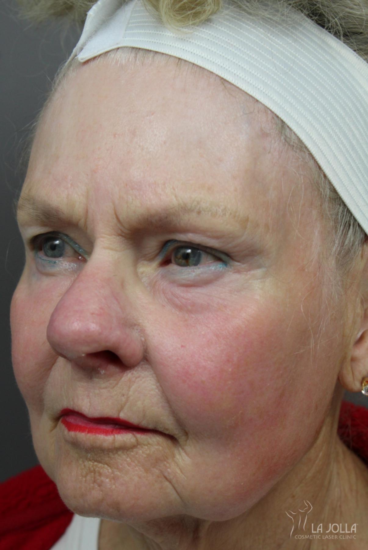 Lasers for Rhinophyma Before & After Gallery: Patient 2