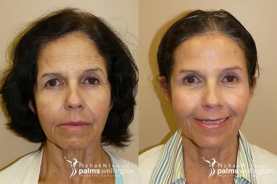 Brow Lift Before & After Gallery
