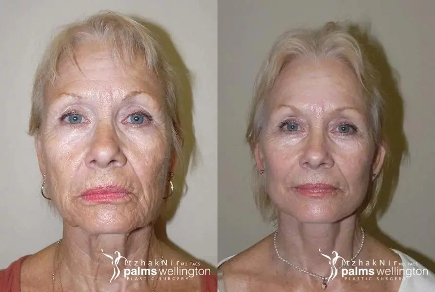 Facelift Before & After Gallery: Patient 11