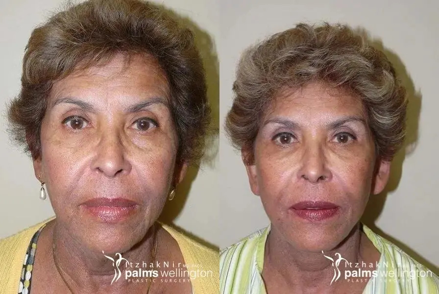 Facelift Before & After Gallery
