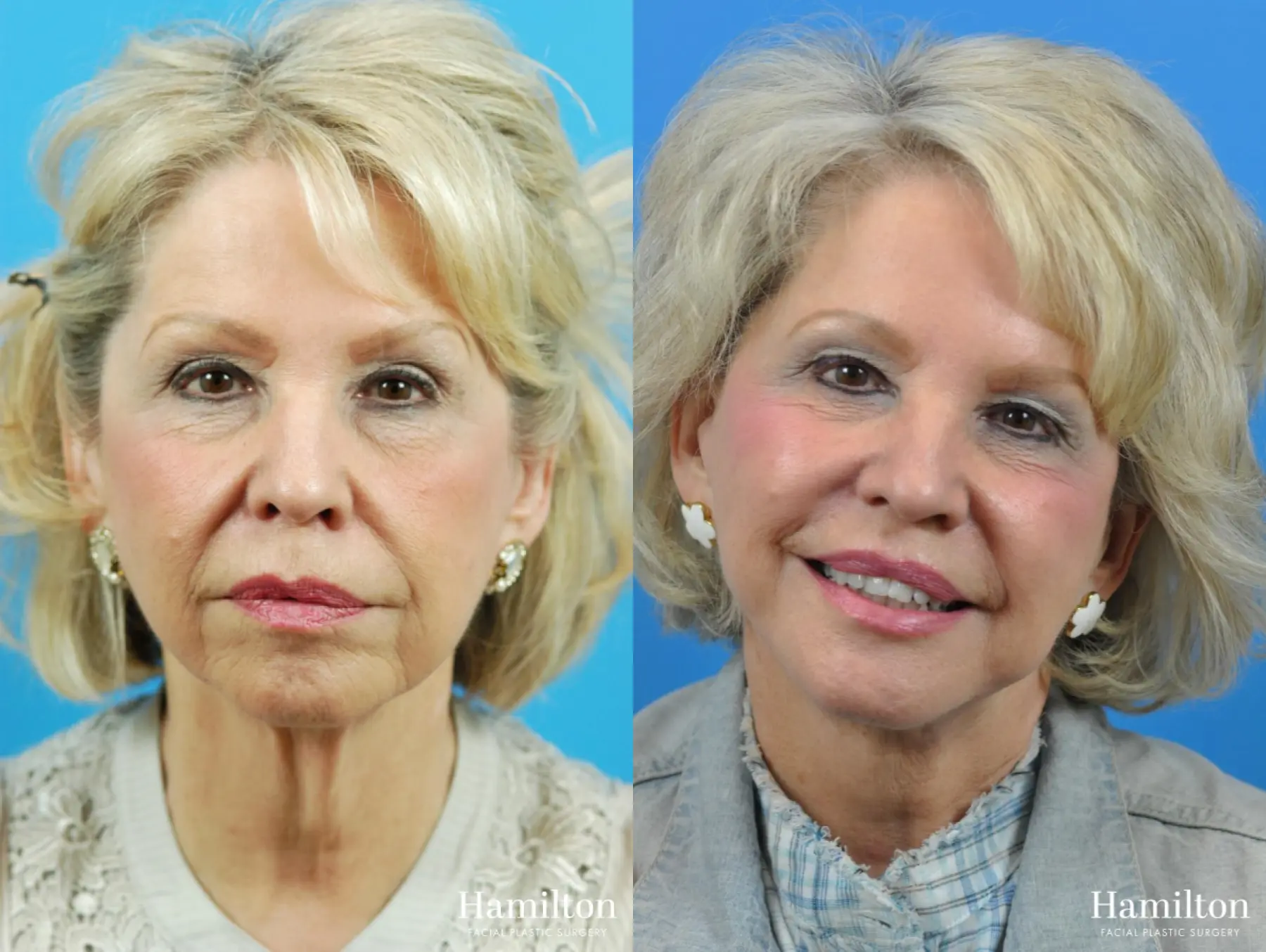Photo Gallery | Hamilton Facial Plastic Surgery
